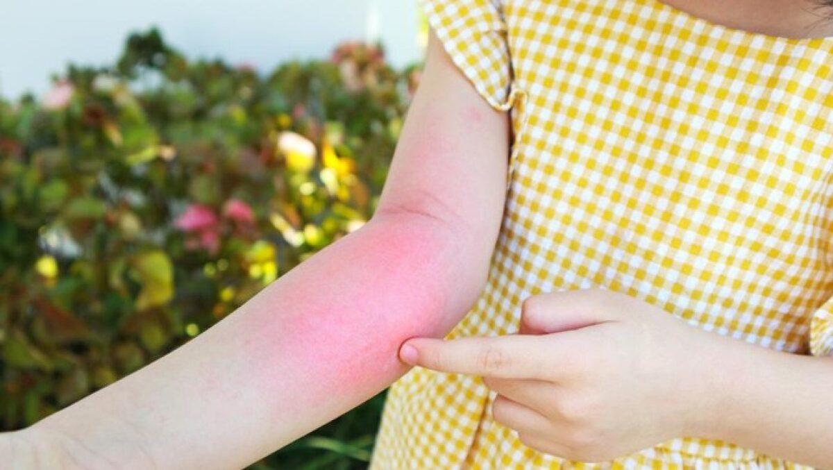 7 Obat Biduran Alami di Dapur, Redakan Gatal dengan Cepat dan Efektif ...